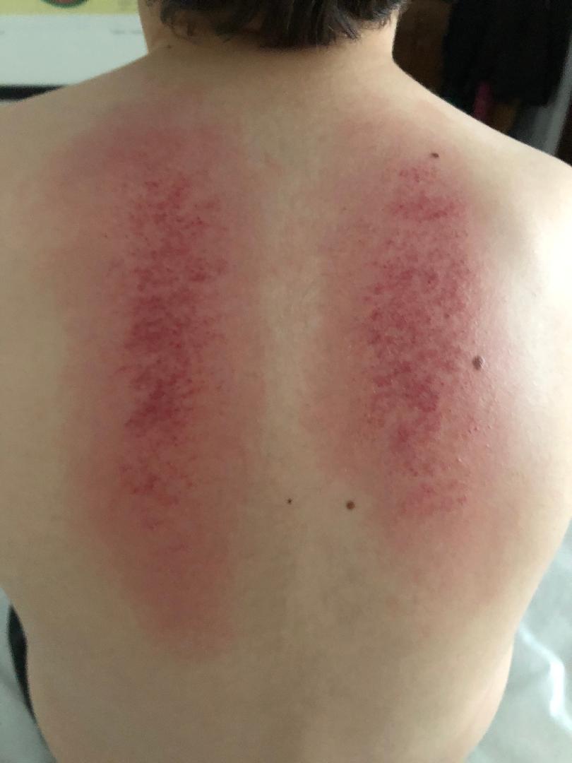 Cupping and Gua sha - Lucy Ward Acupuncture